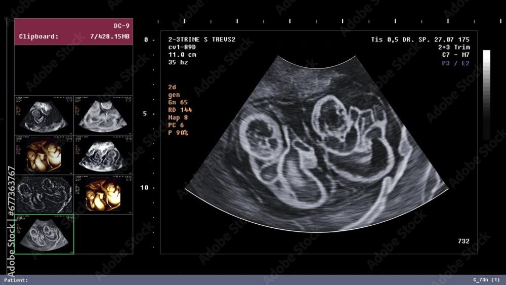 Pregnancy Scanner Uses Sound Waves To Show Twin Babies New Life ...