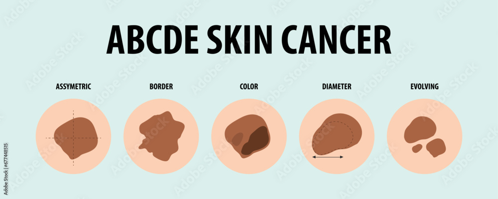 Illustrated Guide to Five Types of Skin Cancer Stock Vector | Adobe Stock