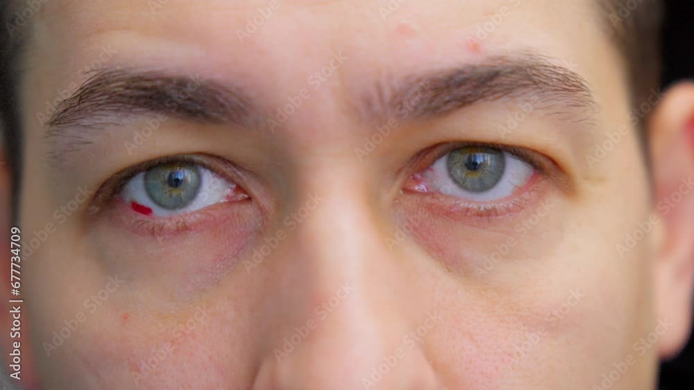 Close up of a bloodshot eye man. Hemorrhage of the eye, rupture of a ...