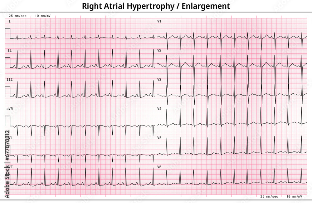 ECG Right Atrial Enlargement (RAE) - Right Atrial Hypertrophy (RAH ...