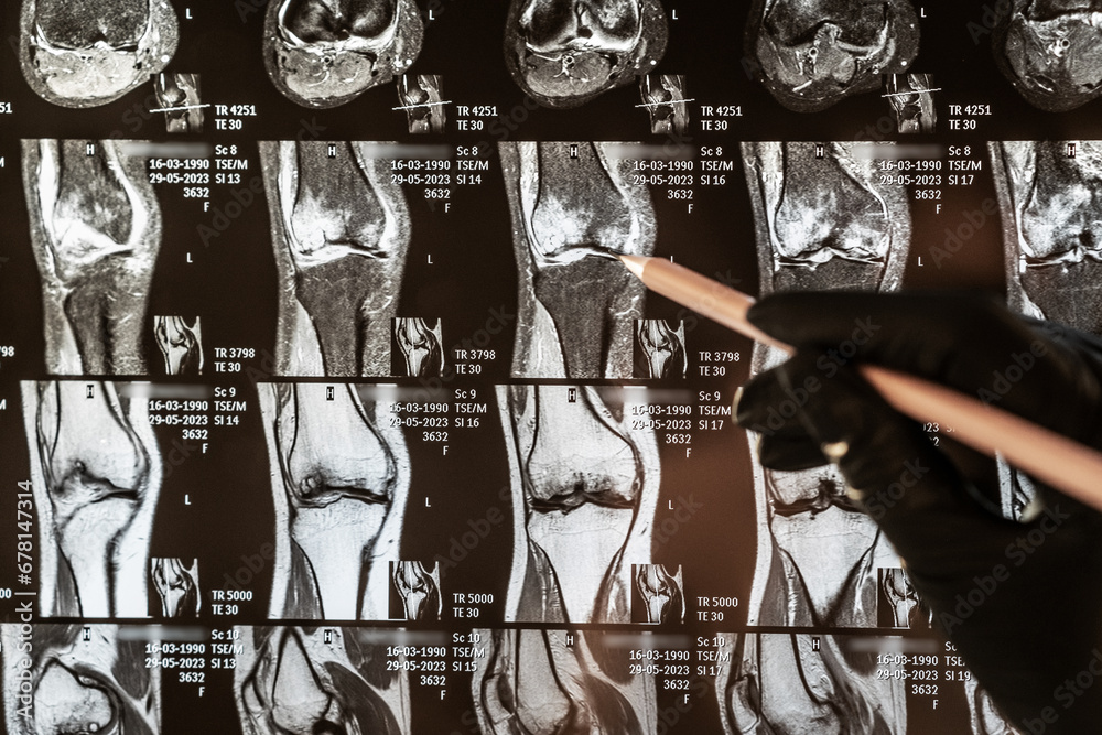 Knee joint x-ray or MRI. Doctor pointed on area of knee joint, where ...