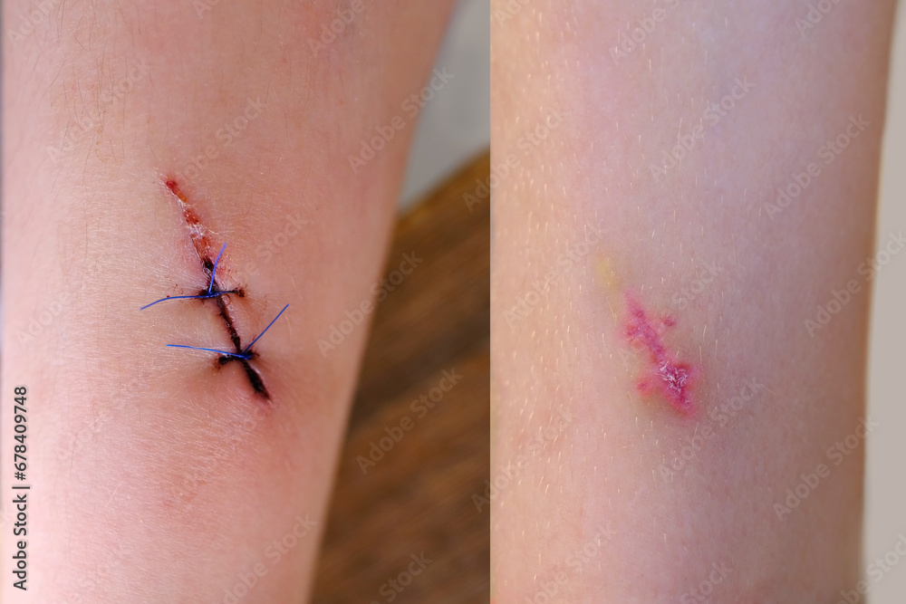 wound on child's leg, wound healing process in child, Before and after ...