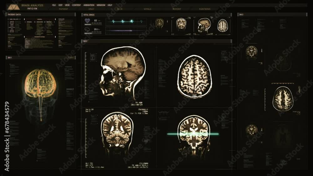 Futuristic Interface Patient Information Showing Several Views of Brain ...
