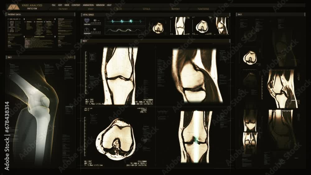 3D Model Animation of Human Knee. Futuristic Patient Medical Interface ...