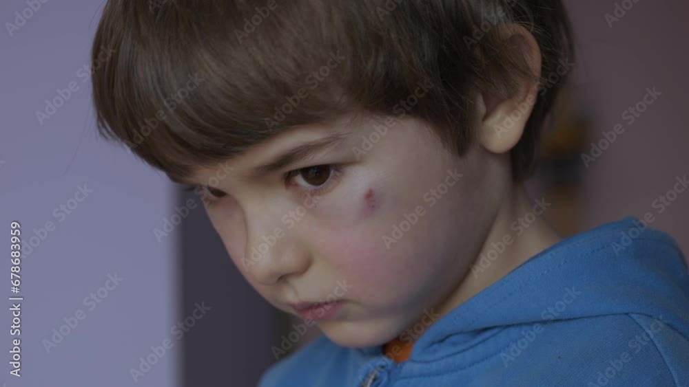 Portrait of Face of Unhappy Boy With Blue And Red Bruise Near Eye. Sad ...