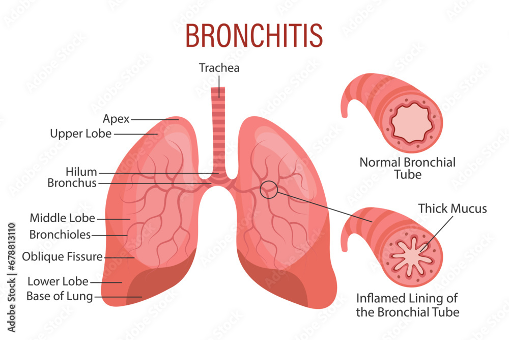 Bronchitis, a lung disease. Healthcare. Medical infographic banner ...
