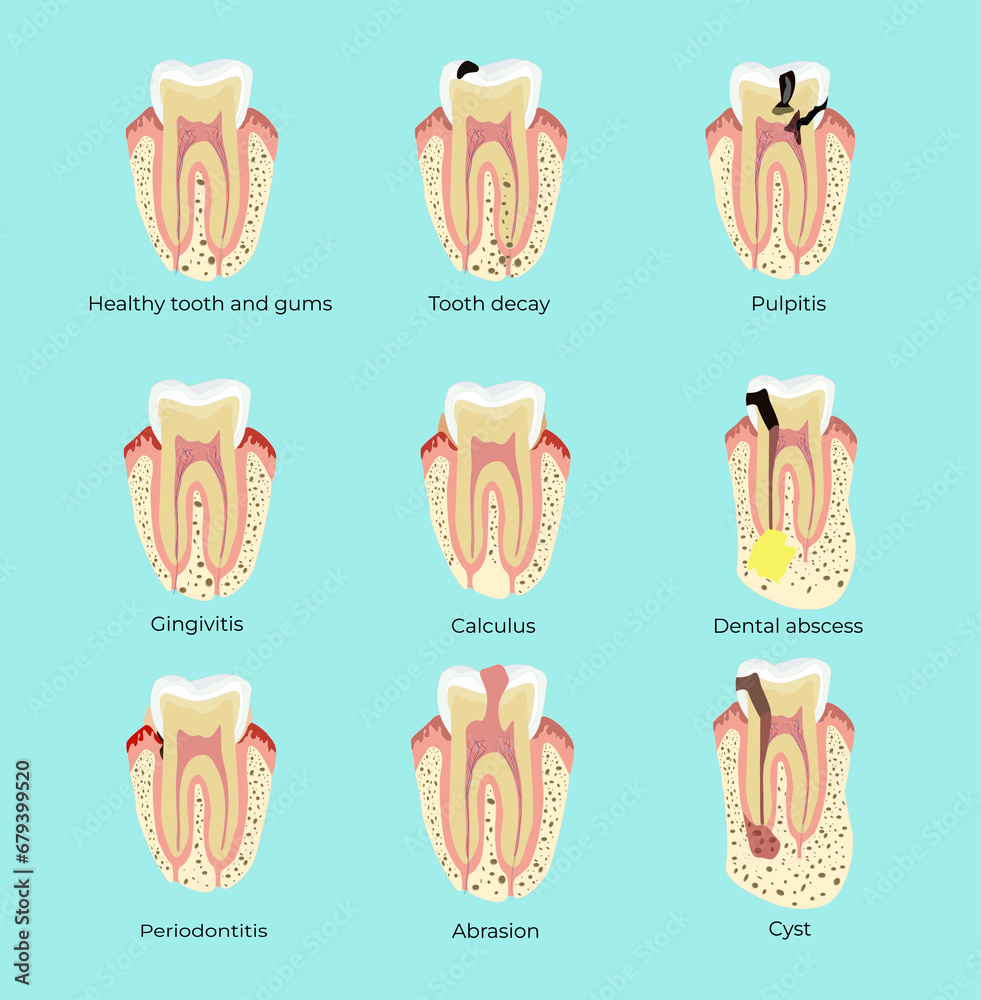 Dental diseases teeth caries pulpitis cyst gingivitis periodontitis ...
