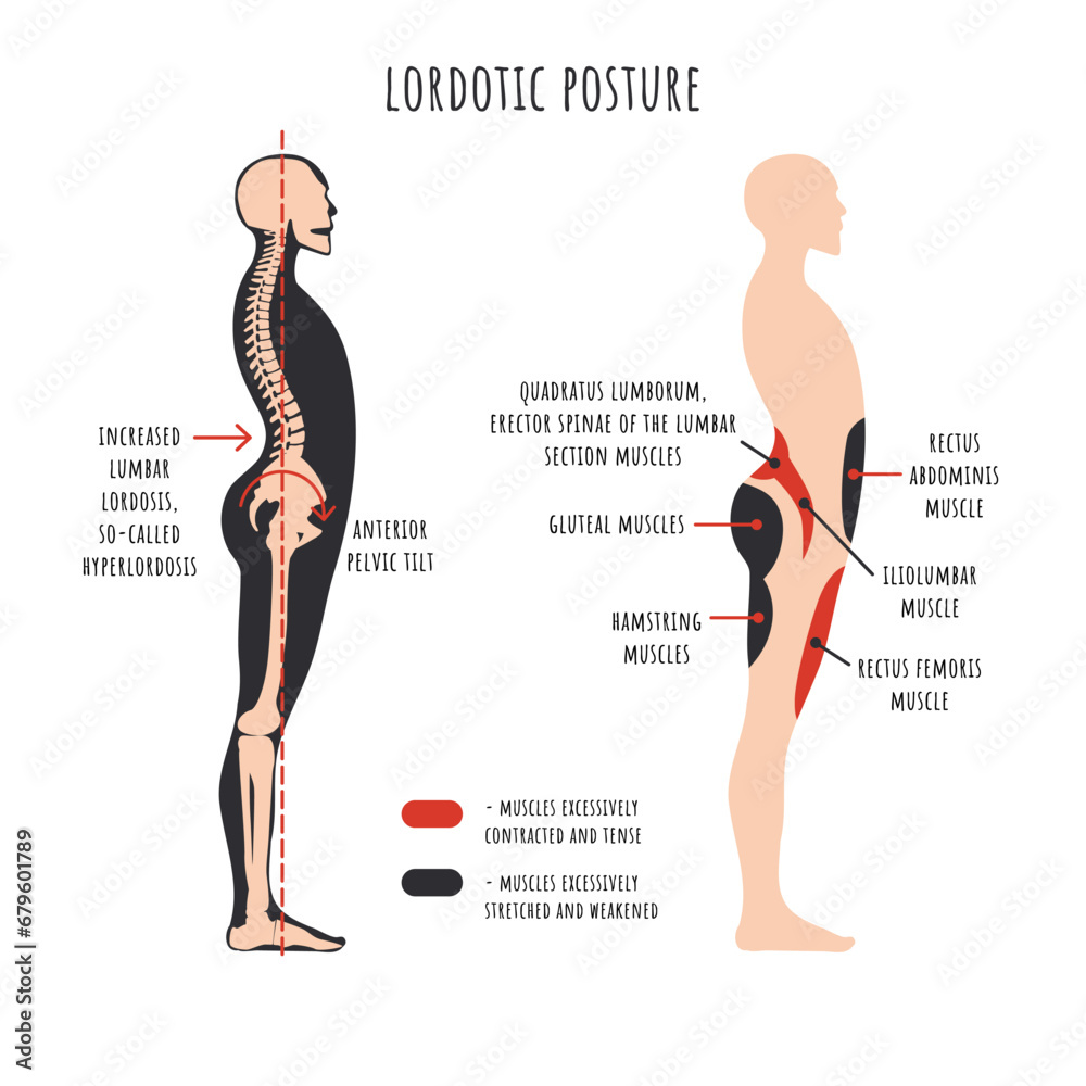 Posture Disorders Infographics Lordotic Posture Side View Shows