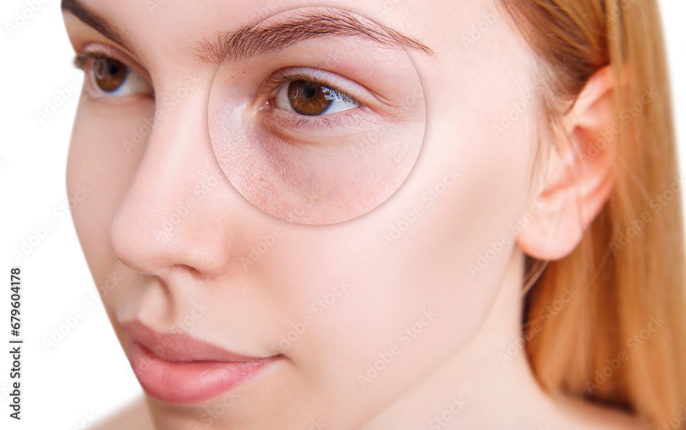 Young woman with bruises under eyes before and after treatment. Stock ...