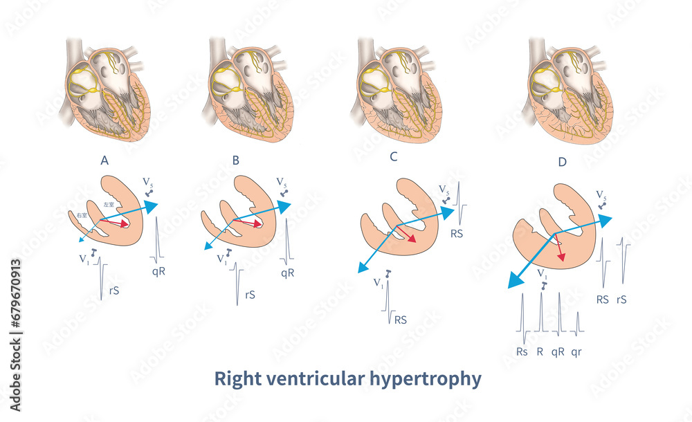Naklejka During ventricular depolarization, varying degrees of right ...