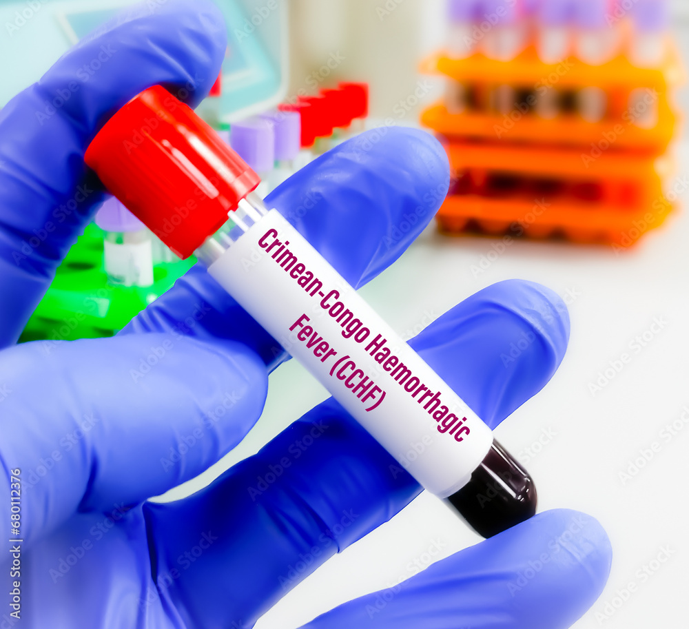 Blood sample for Crimean Congo hemorrhagic fever(CCHF) test. Tick borne ...