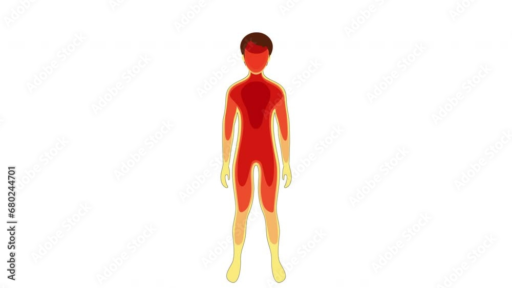 Hyperthermia. Changes in a Body temperature during heat stroke. A ...