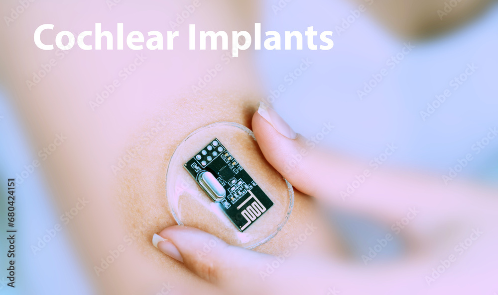 Cochlear Implants Implantable Electronic Medical Devices Concept Stock ...