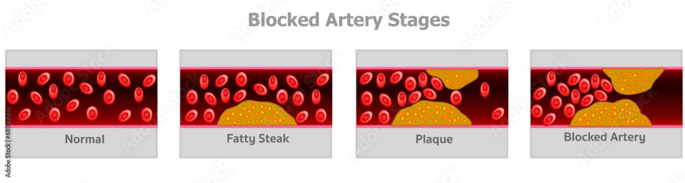 Blocked artery, blood vessels stages. Fatty steak, plaque. flow red ...