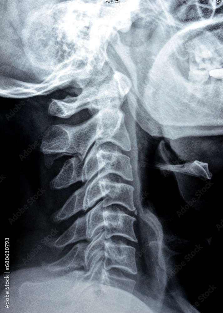Plain X ray of cervical spine revealed straightened cervical curve ...