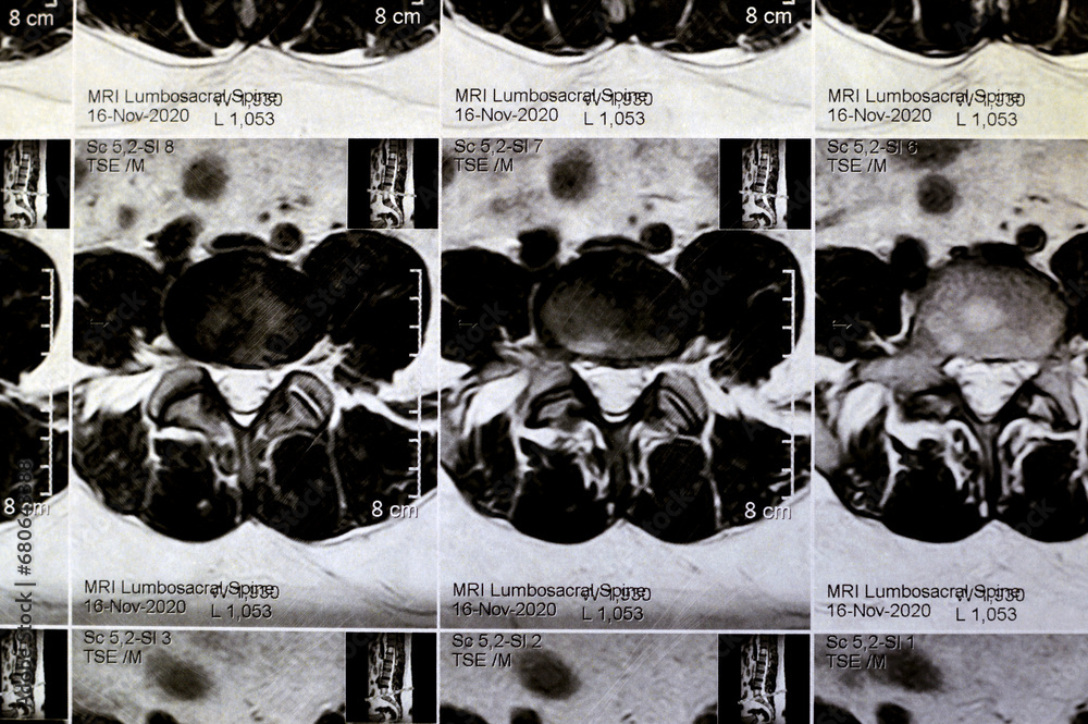 MRI lumbosacral spine without contrast revealed back muscle spasm, Mild ...