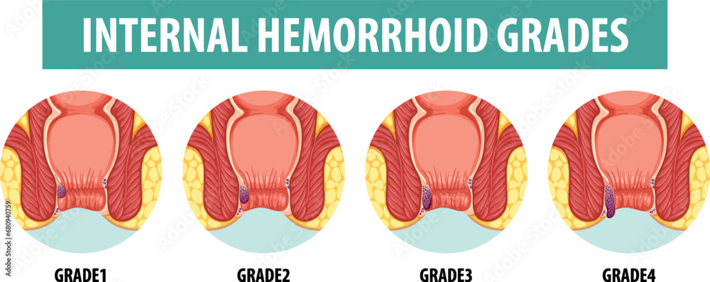 Vecteur Stock Anatomy of Human Internal Hemorrhoid in Different Grades ...
