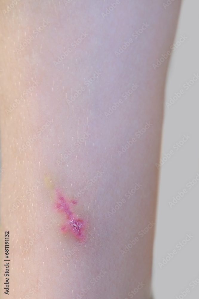 Healing scar, stitched wound on child's leg, wound healing process in ...