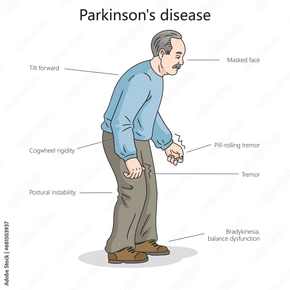 Man patient with Parkinson disease diagram hand drawn schematic vector ...