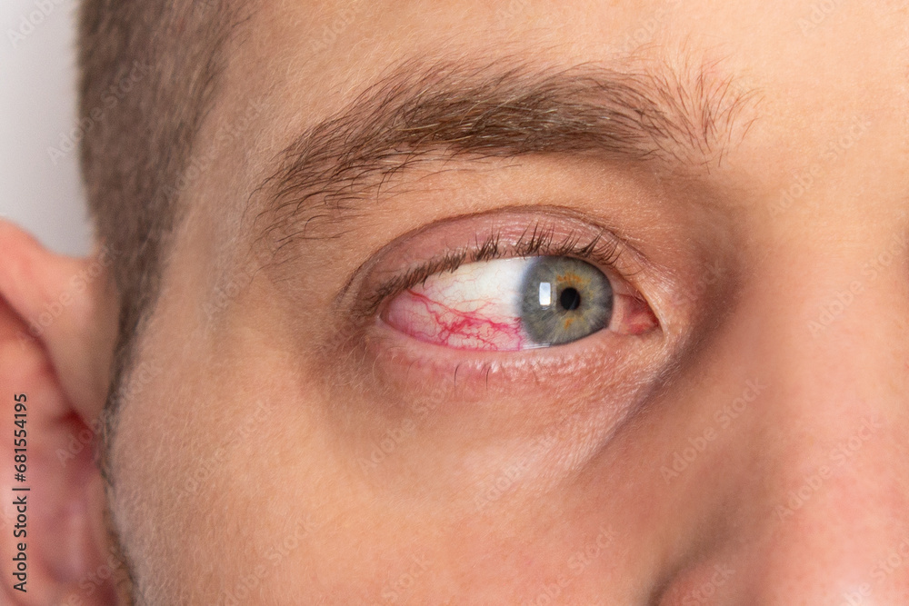 Red male eye with damaged blood vessels close-up. Retinal diseases ...