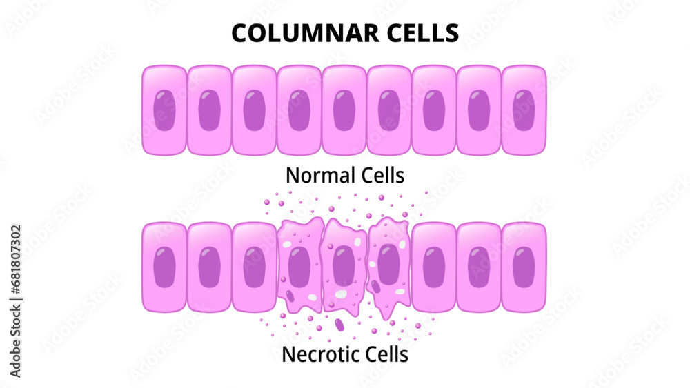 Columnar Cells - Normal Epithelial Cell - Necrotic Cell - Medical ...