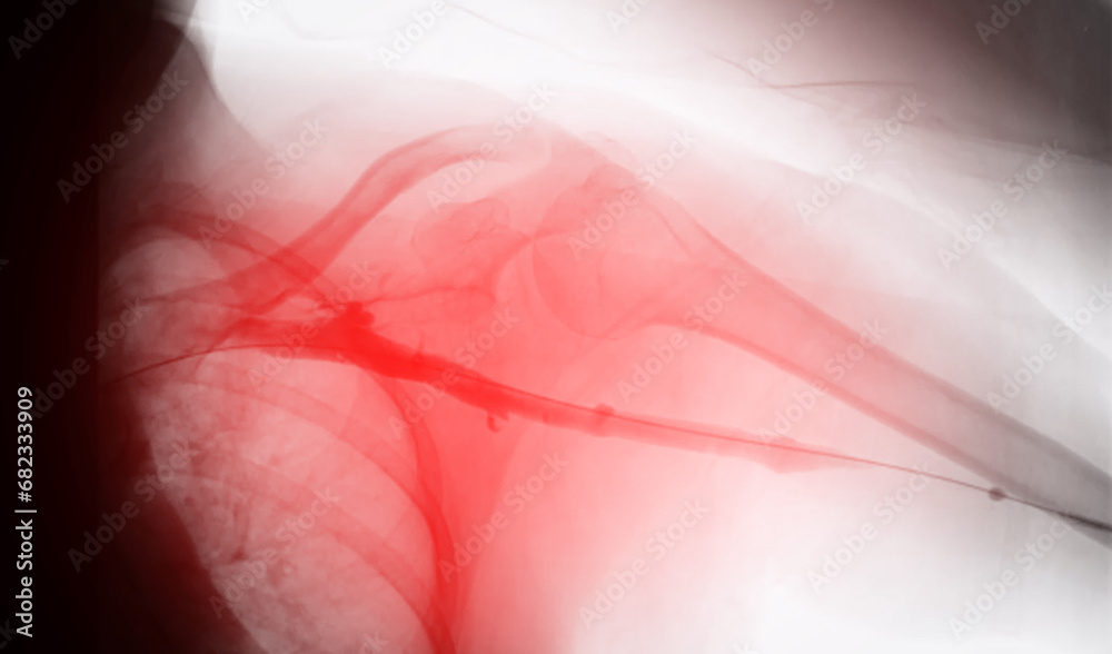 Balloon Angioplasty is a medical procedure used to widen narrowed or ...