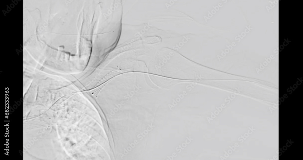 Balloon Angioplasty is a medical procedure used to widen narrowed or ...