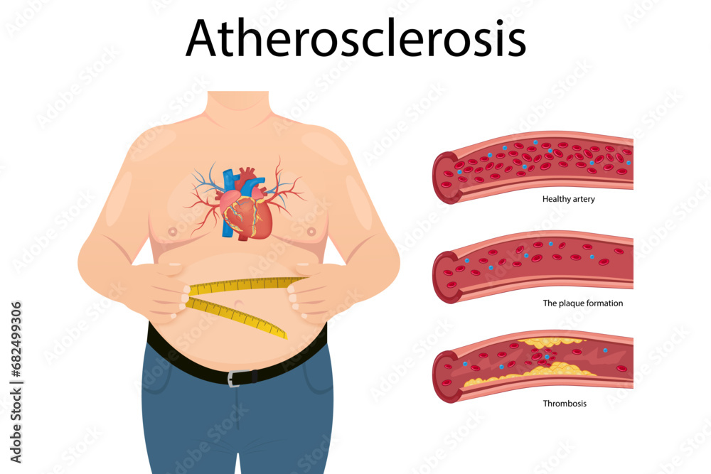 Illustration of a heart with coronary artery disease, a major blood ...