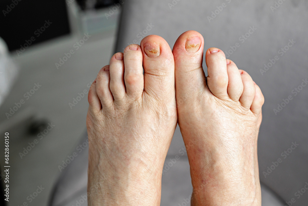 Nails of a 70-year-old woman with a defect of thickening on the foot ...