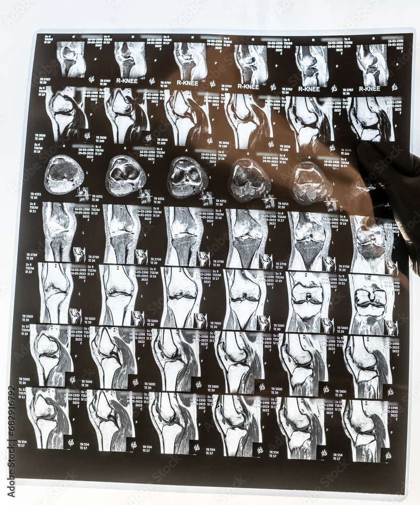 Knee joint x-ray or MRI. Doctor pointed on area of knee joint, where ...