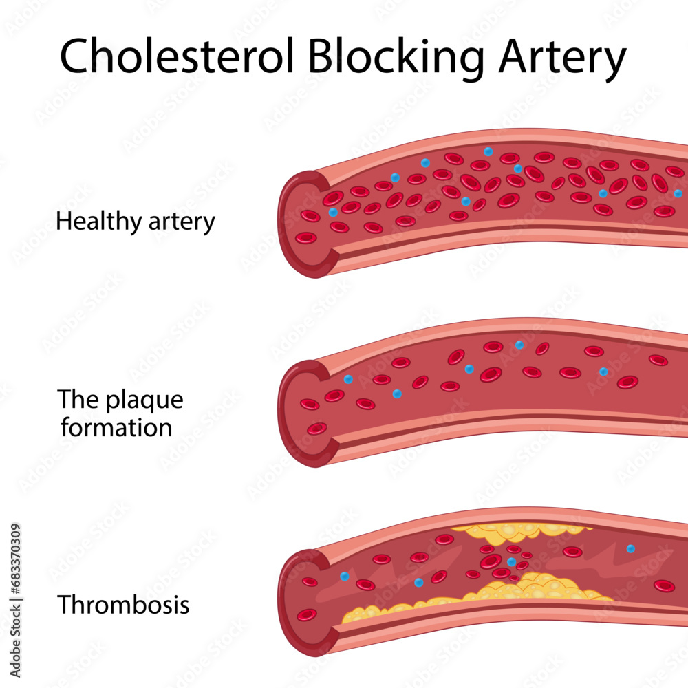 Healthy and narrowed blood vessels with accumulation of cholesterol ...