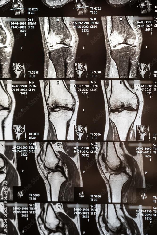 Knee joint x-ray or MRI. Doctor pointed on area of knee joint, where ...