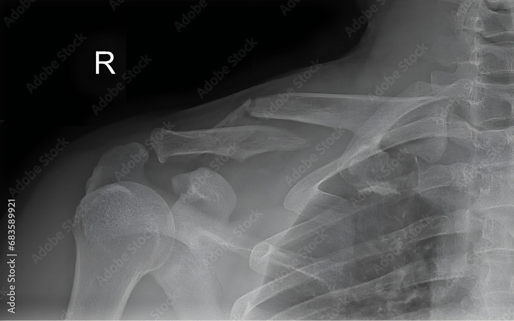 X-ray revealing a clavicle fracture, with clear delineation of the ...