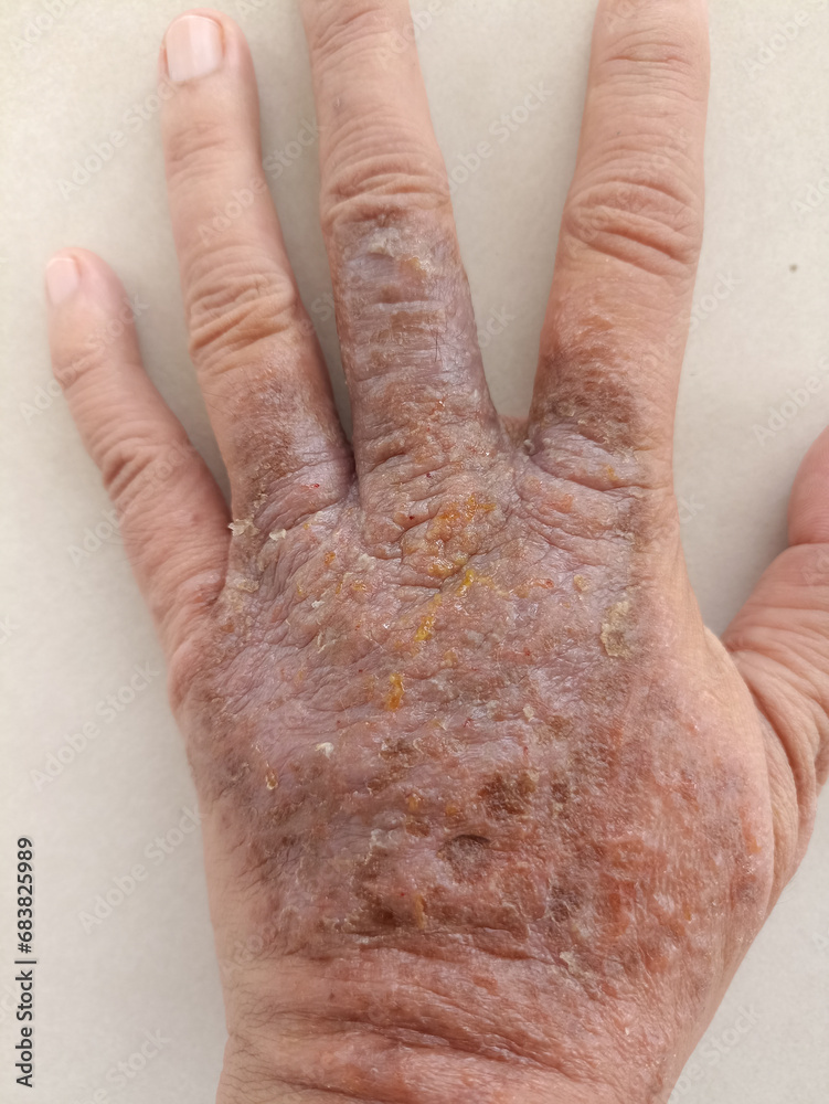 rash eczema dermatitis on hand. inflammation of skin Stock Photo ...
