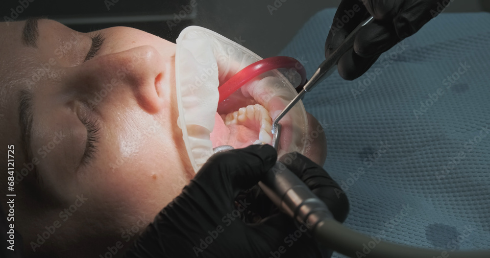 Dentist cleans the plaque, side view close-up. Ultrasonic drill, water ...