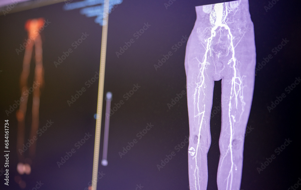 CT image of chronic arterial occlusion in Superficial femoral ...
