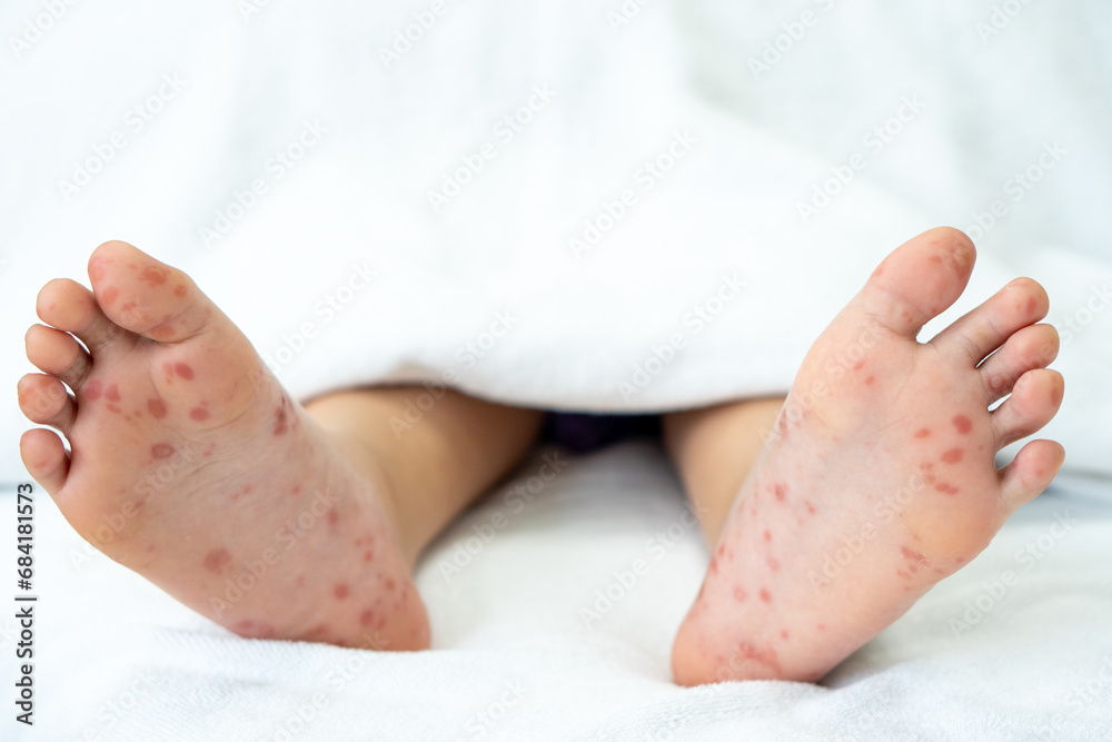 Enterovirus foot red spots blisters on the skin of on the body of a ...