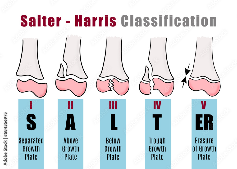 Salter - Harris classification to to recognize and identify different ...