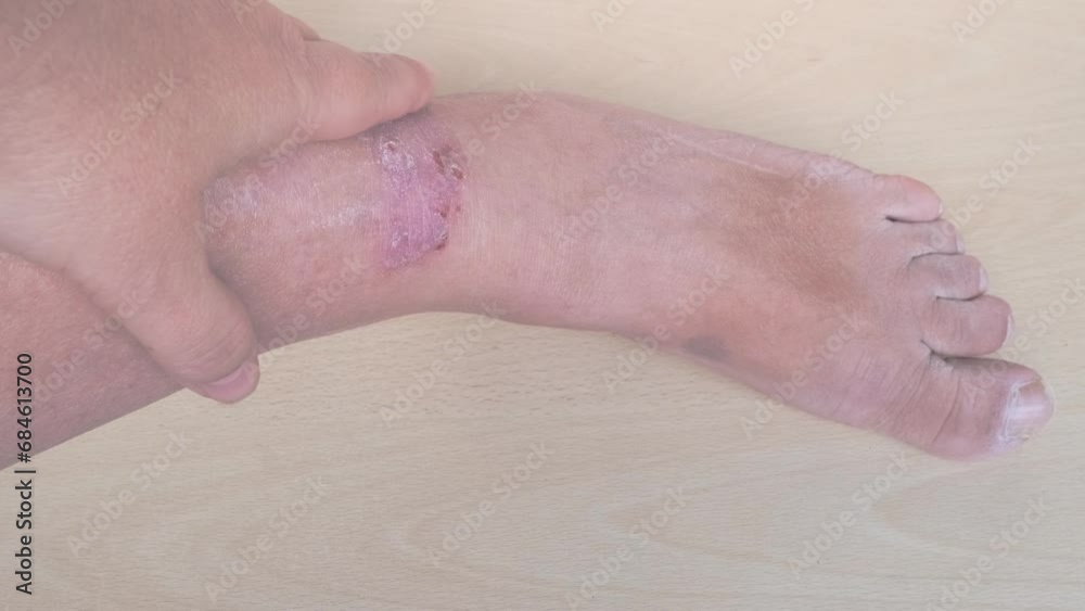 Rash Hives Itchy Skin On Leg Inflammation And Medical Allergies