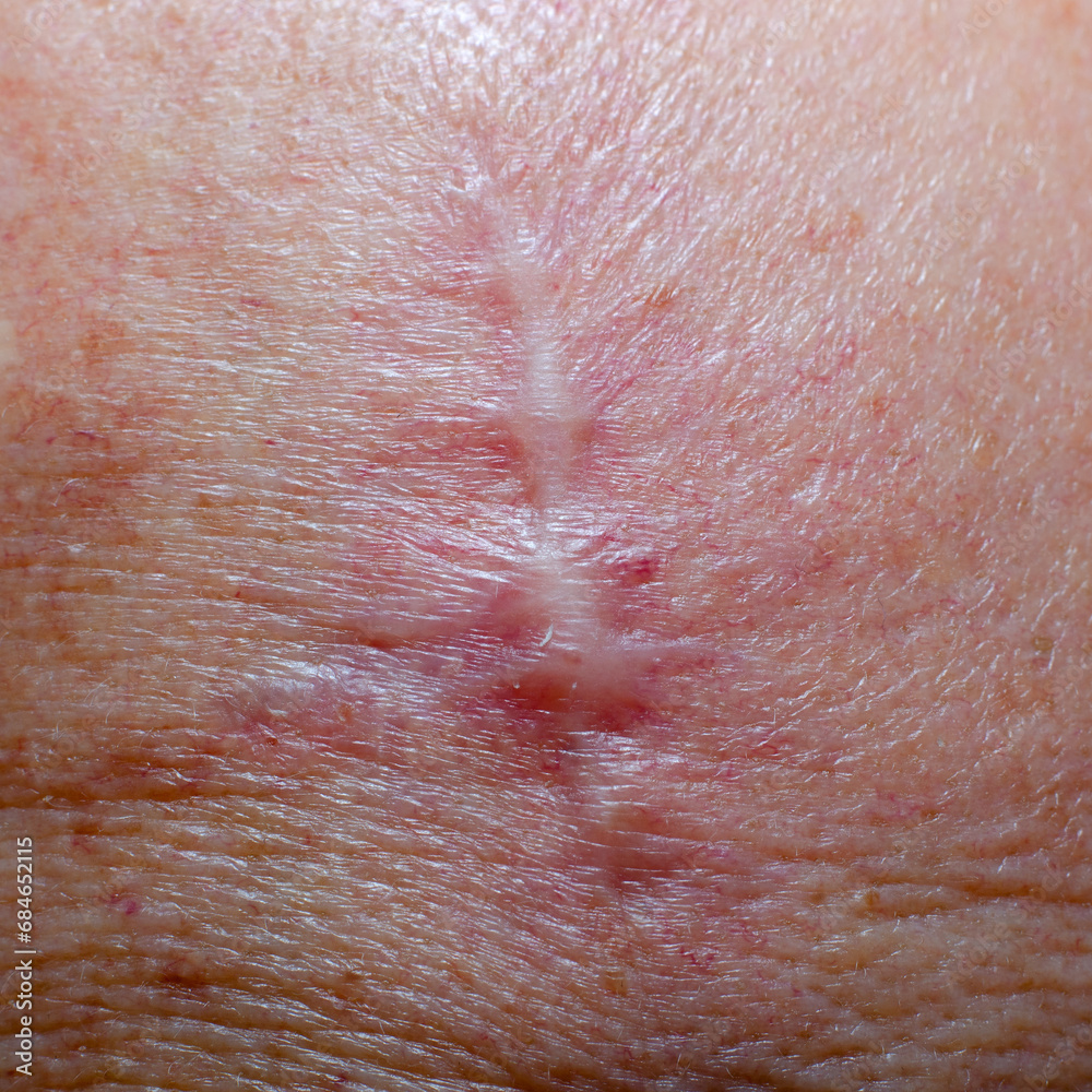 Scar with threads after removal of skin cancer on the head Stock Photo ...