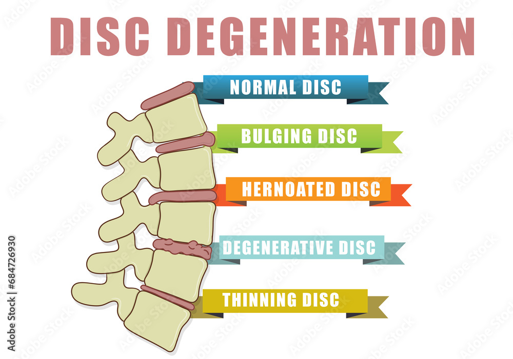 Poster Disc degeneration diagram with condition exampes - bulging ...