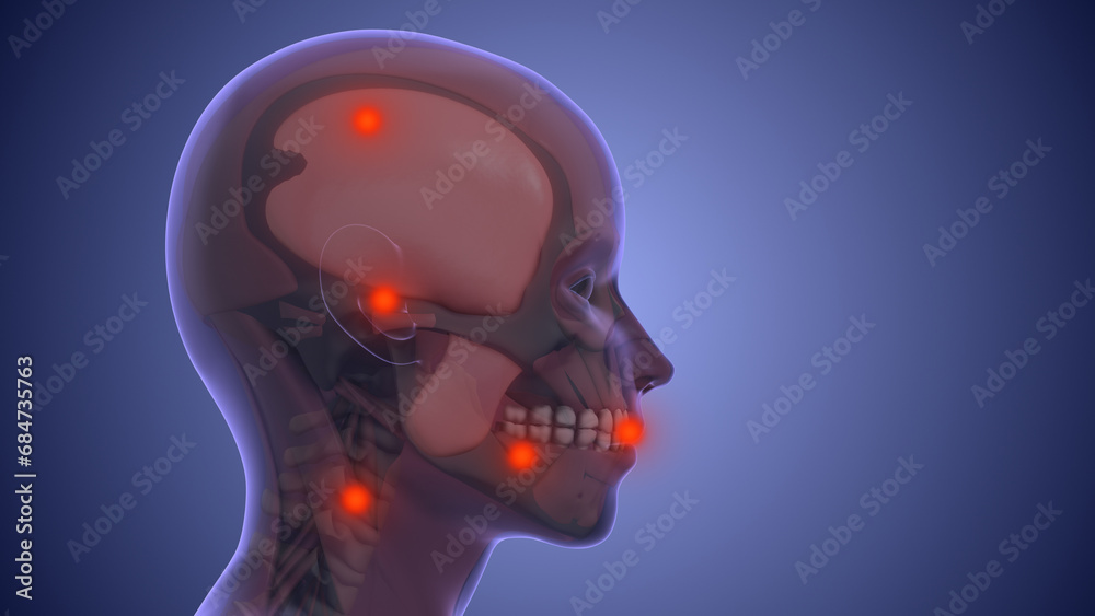 Plakat Referred pain from muscle trigger points in the masticatory and ...