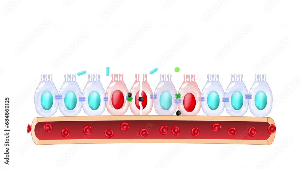 Leaky gut Syndrome. difference between Healthy cells, and inflamed ...