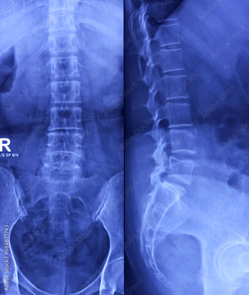 X-ray of Lumbosacral spine AP and Lateral view. Early degenerative ...
