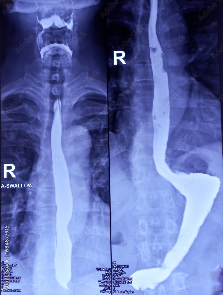 Barium swallow of oesophagus examination x-ray. showing upper digestive ...