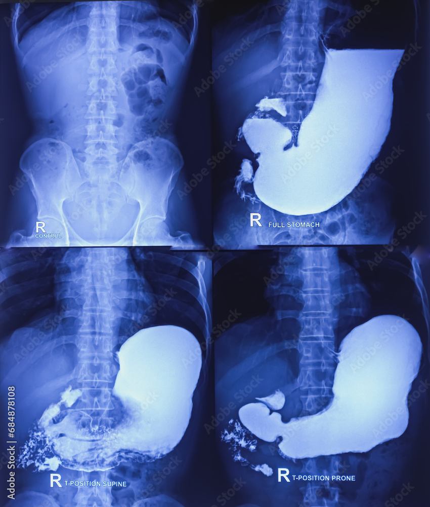 Barium swallow of oesophagus examination x-ray. showing upper digestive ...