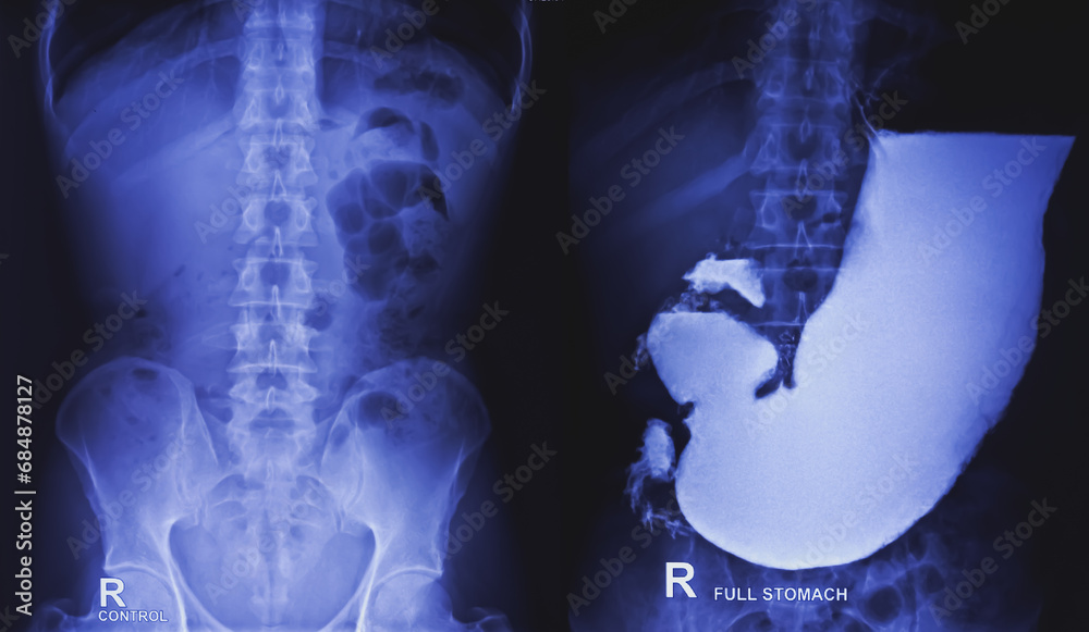 Barium swallow of oesophagus examination x-ray. showing upper digestive ...