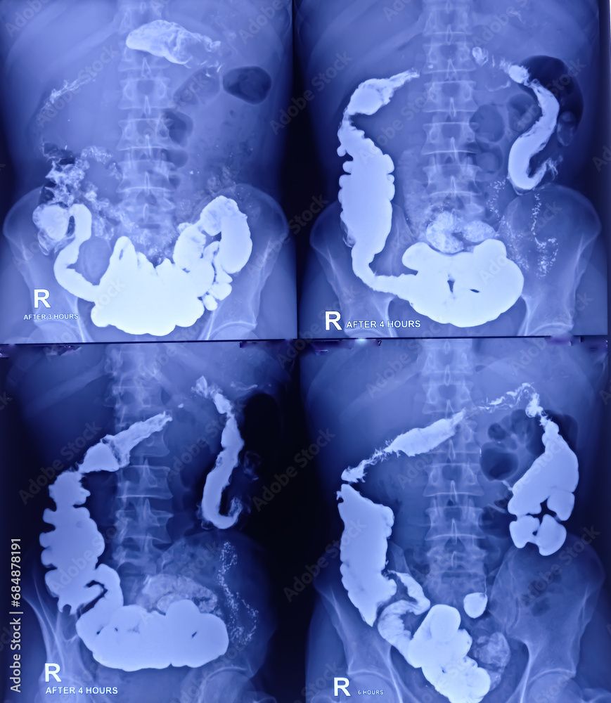 Barium swallow of oesophagus examination x-ray. showing upper digestive ...