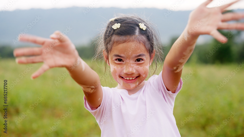 Little cute alpha young albino vitiligo small girl relax toothy smile ...