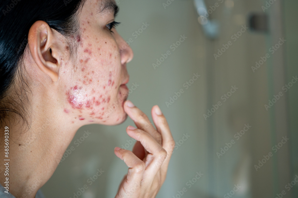 Acne on face because the disorders of sebaceous glands productions ...